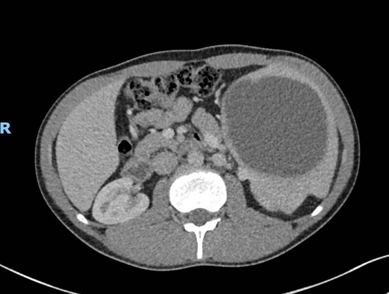 What Causes Abdominal Cysts? A Look into Risk Factors - Surgery for ...
